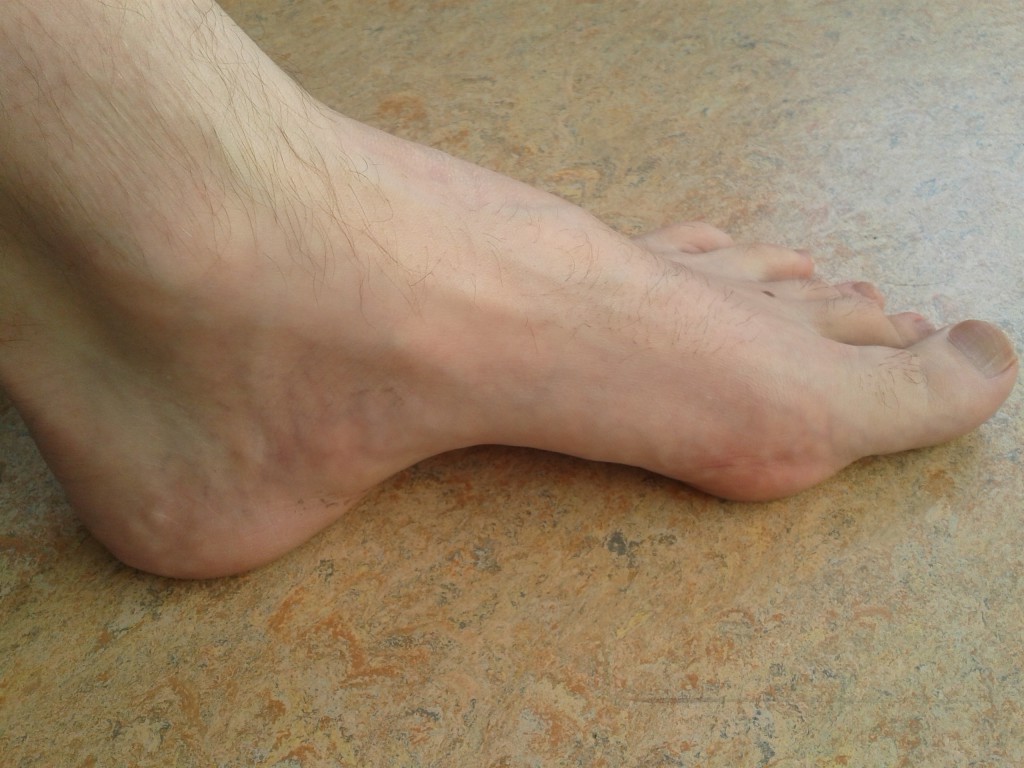 Plantarfasziitis mit Hohlfuß - iknowbetter.de